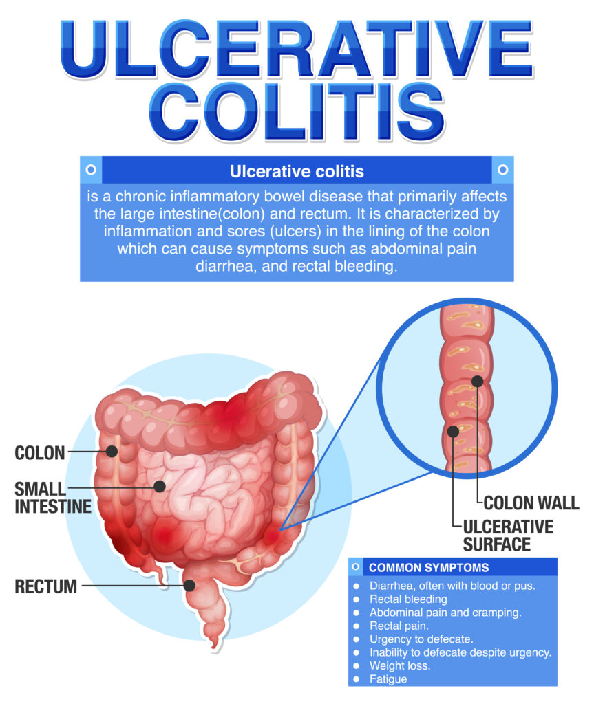 Homeopathic Medicine For Colitis - HOMOEO HEALING